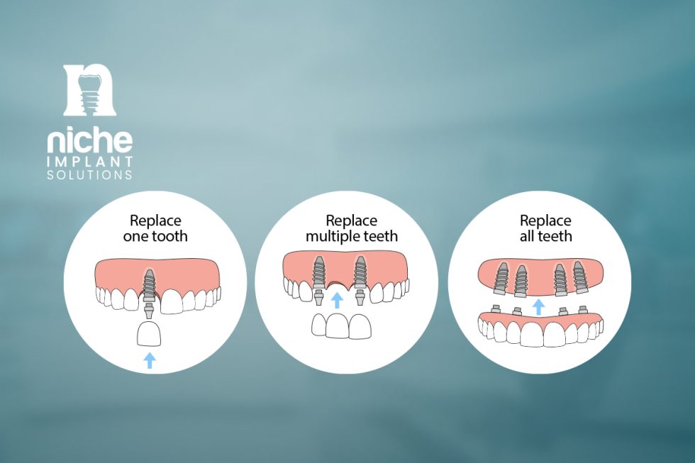 four types of dental implants | Know it from Niche now