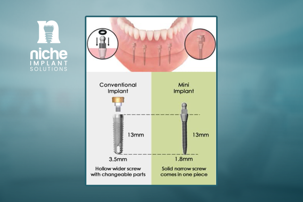 Mini dental implants | Get it now from our website | Niche