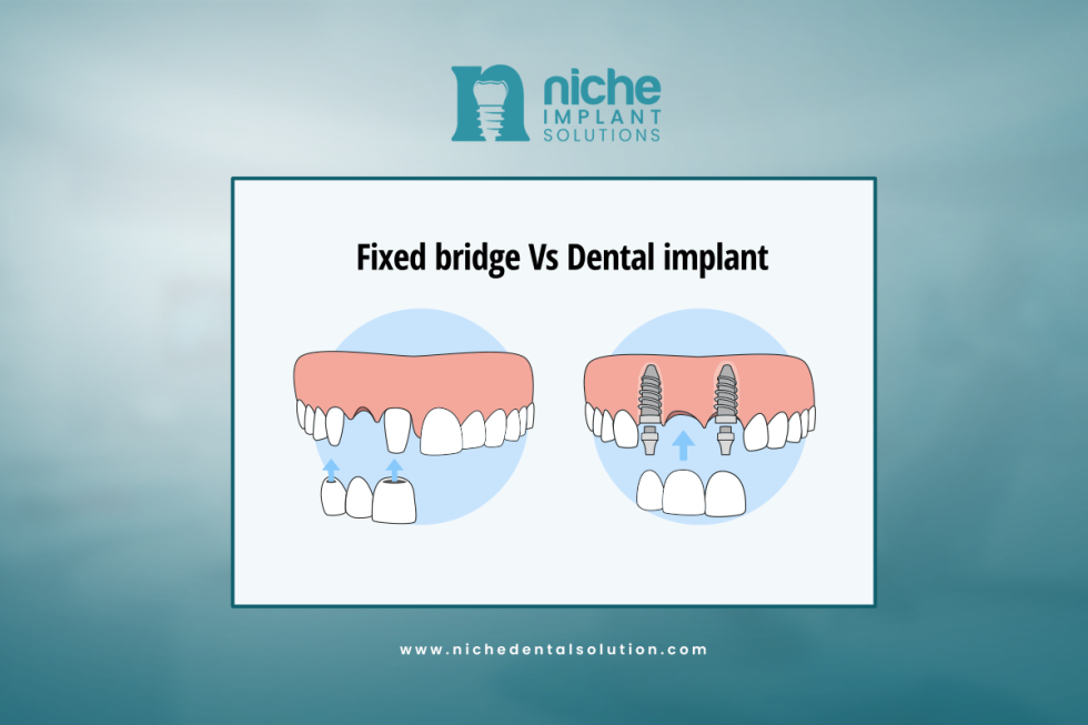 Dental implant vs. bridge | Know the difference now