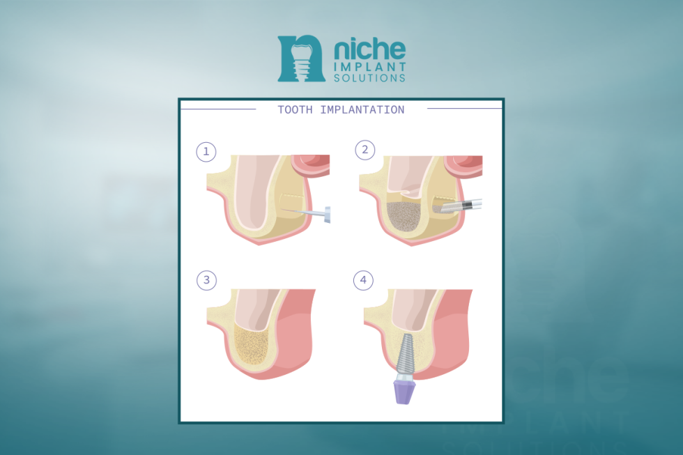 sinus lift for dental implants | Know it from Niche Now