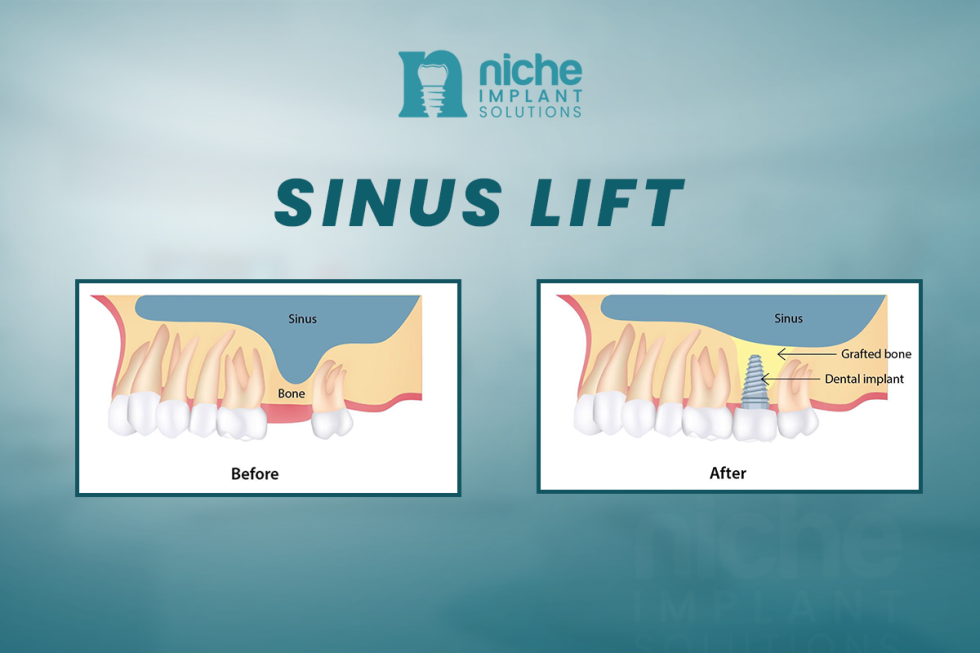 sinus lift for dental implants | Know it from Niche Now