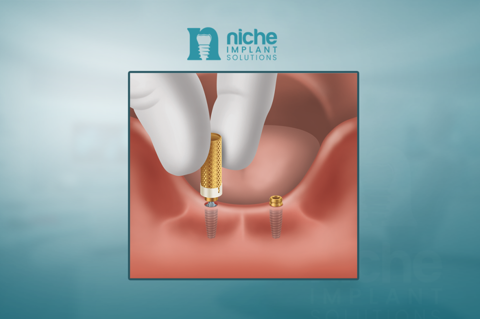 zest locator abutments | Order it from niche now